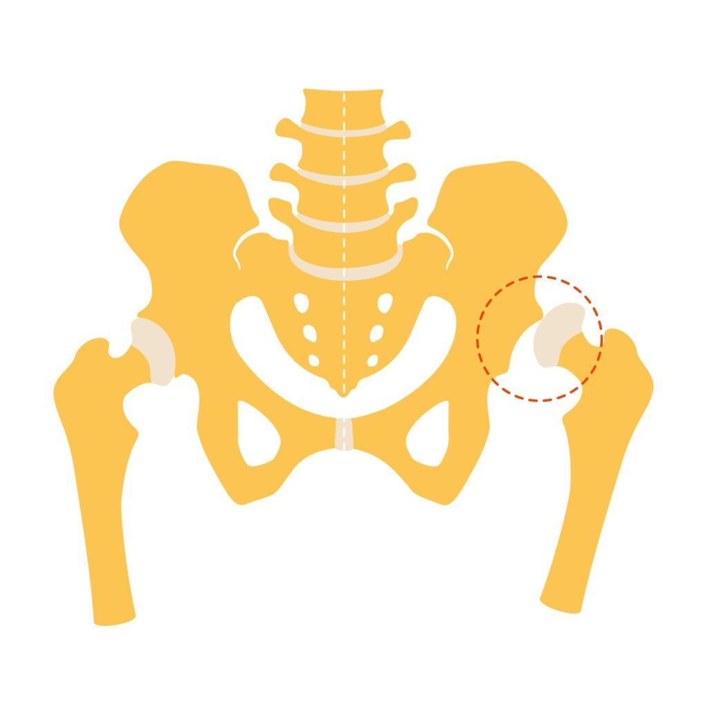 Dislocation Of Hip In Children - Orthopaedics